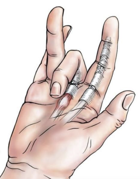 DEDO EN GATILLO :: Borja Cuevas - Cirugía de mano en Bilbao